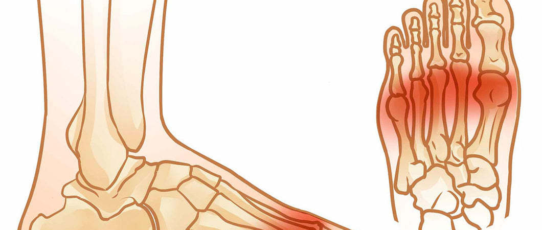 Comprehensive Guide to Overcoming Metatarsalgia and Achieving Long-Ter ...