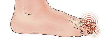 Exercises & Treatments to Help Improve and Prevent Hammer Toe – Fits ...