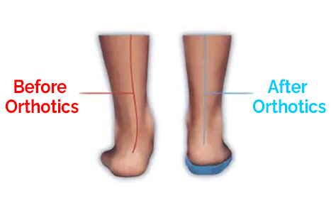 Correct Your Supination With Custom Orthotics, Stretches, & Exercises ...
